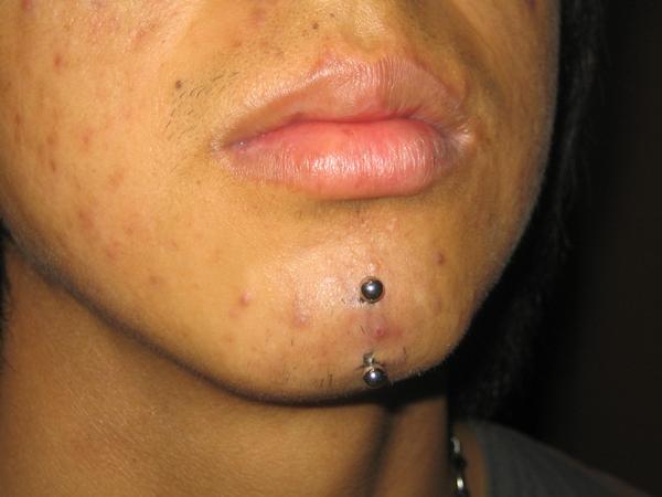 ¡Todo sobre la curación del piercing del hueco del mentón!